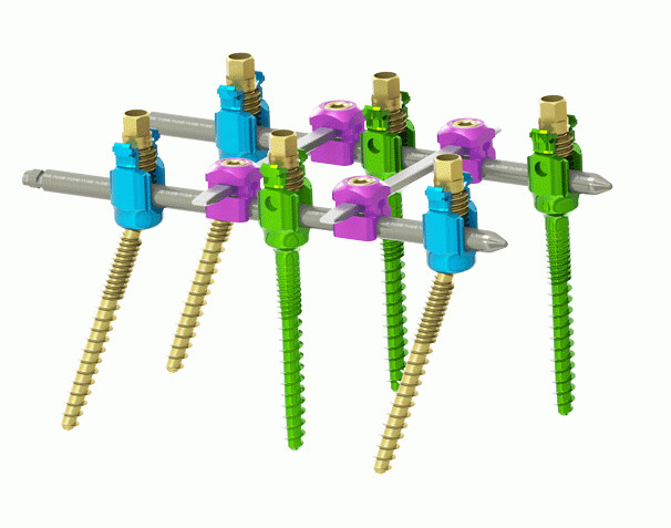 Minimally Invasive Internal Spinal Fixation System