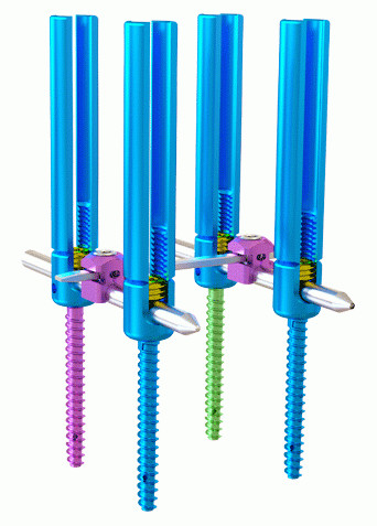 Internal Spinal Fixation System Type Ⅰ Minimally Invasive