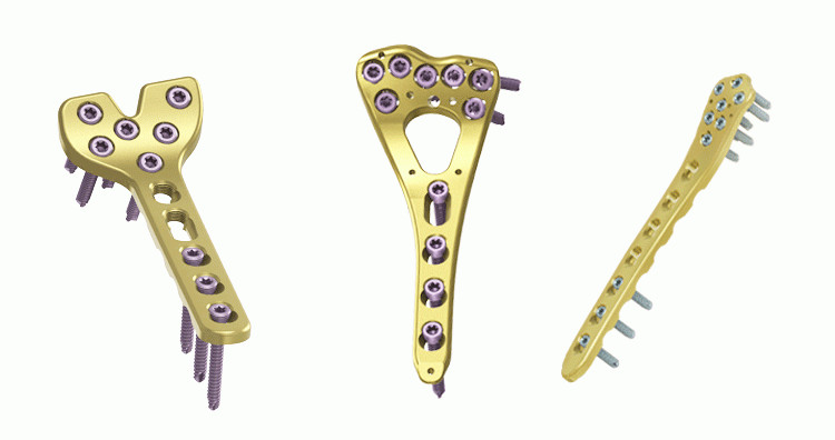 Variable Angle Locking Plate