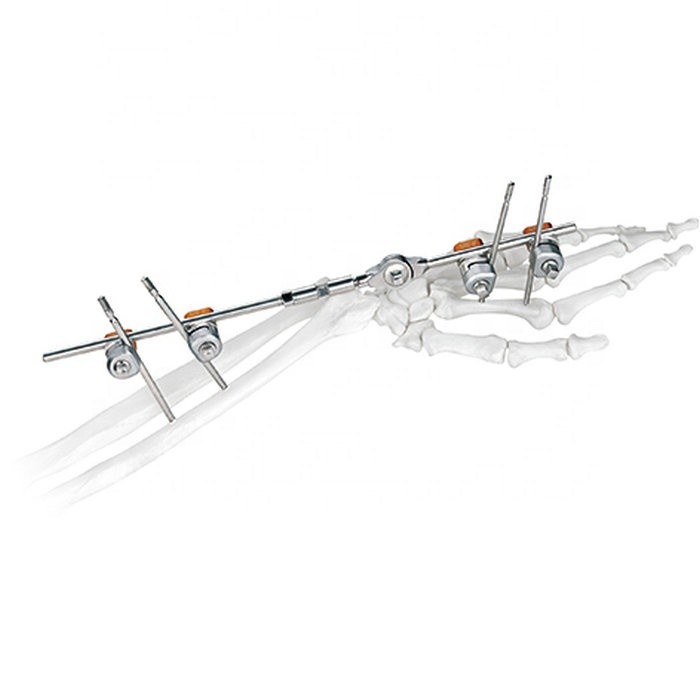 Medical Orthopedic Surgical Implant Joint Wrist External Fixator